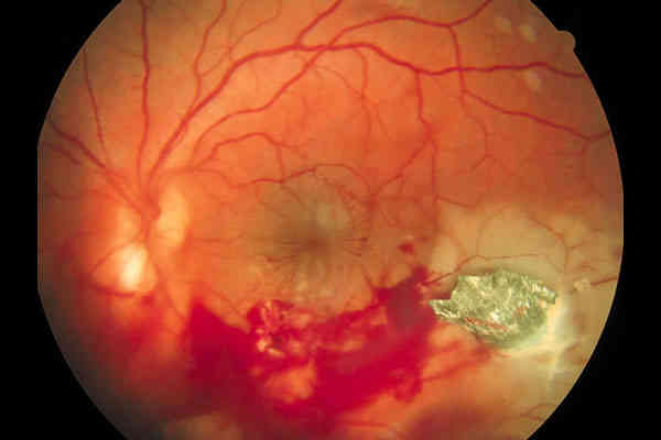 con hemorragia vítrea